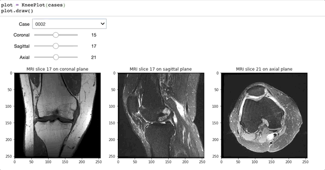Analysis of the MRNet Knee MRI dataset | TDS Archive