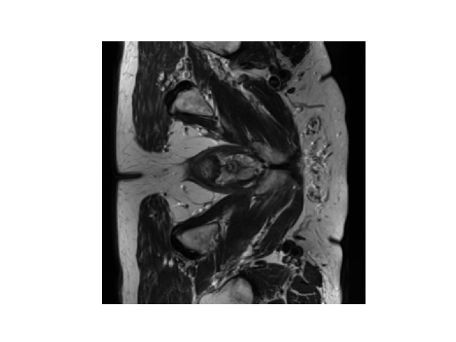 Prostate Mri Segmentation Image Segmentation Is A Crucial Aspect… By Pauline Ornela Megne