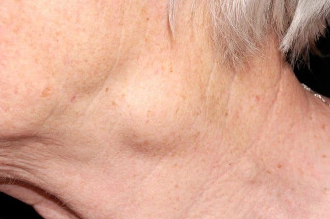 When to suspect cancer, lumps touched on the neck, chest, and groin ...