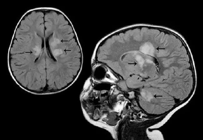 Neuroimmunology and pediatric MS. Multiple Sclerosis (MS) is a chronic ...
