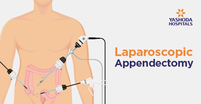 Mastering Appendicitis: A Laparoscopic Approach to Swift Recovery ...