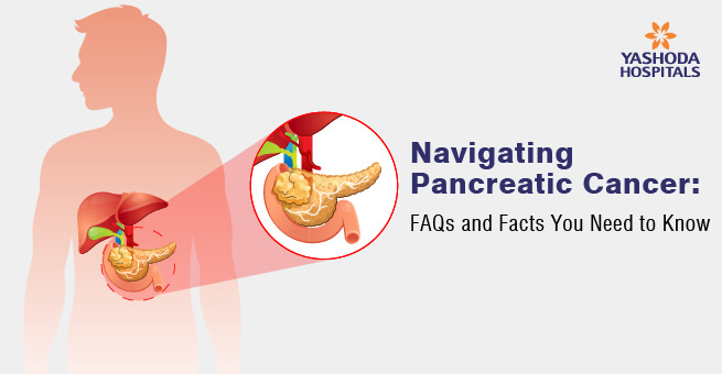 Navigating Pancreatic Cancer: FAQs and Facts You Need to Know - yashoda ...