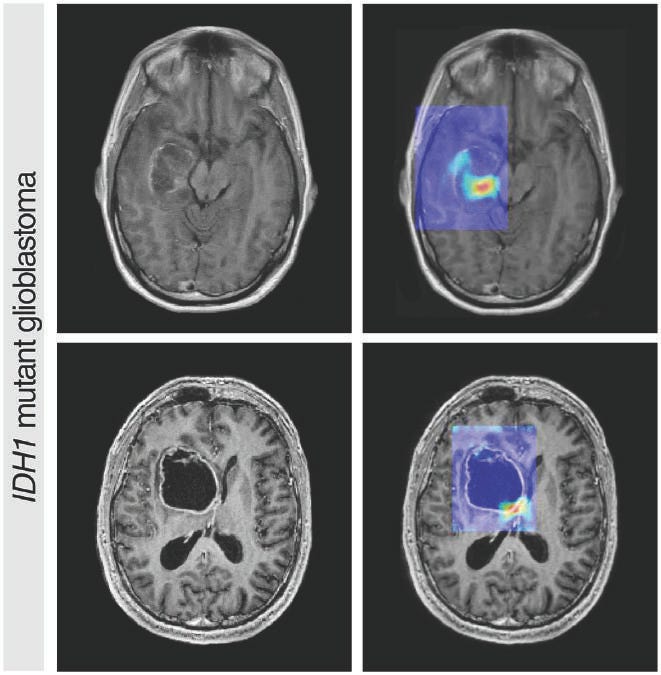 “Revolutionizing Cancer Prevention: The Role of AI in Early Detection ...