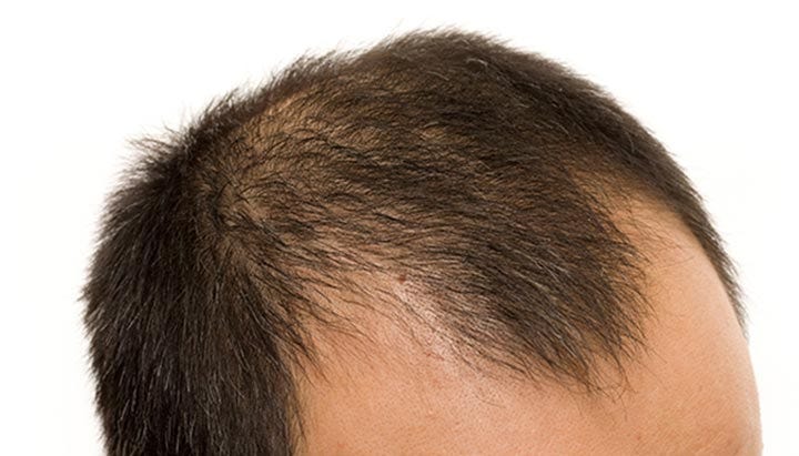 Male Pattern Baldness (Androgenic Alopecia): Stages, Treatment | by Dr ...