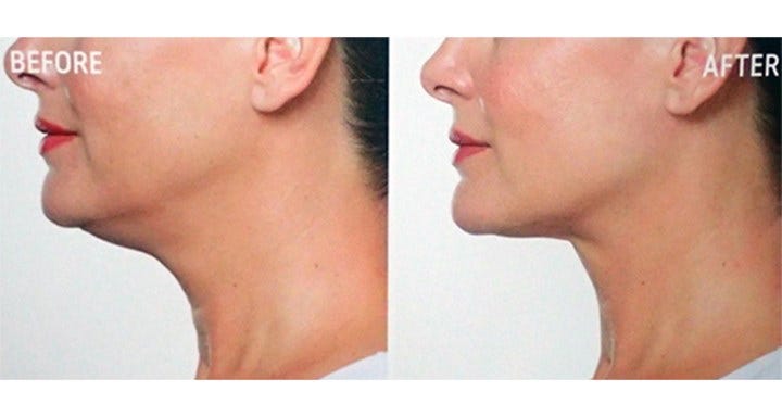 Kybella Chronicles: Unveiling the Neck-Defining Trend in Sydney | by ...
