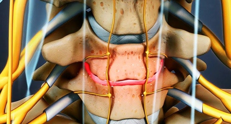 What Is A Degenerative Disc Disease? | by Arun Saroha | Medium