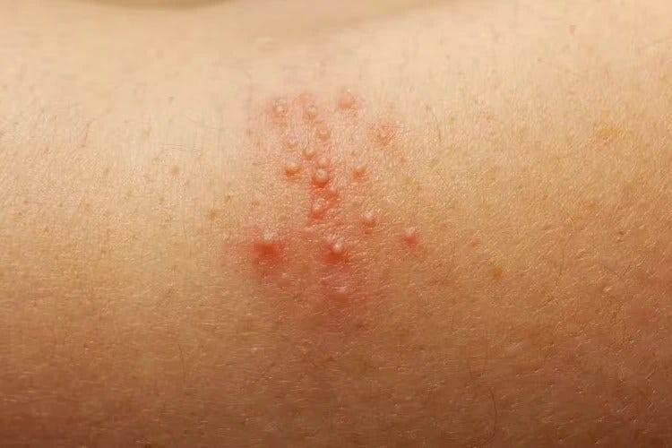 Understanding Heat Rash: Symptoms and Treatment - TBM - Medium