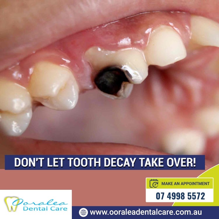 Don’t Let Tooth Decay Take Over — Ooralea Dental Care | by ...