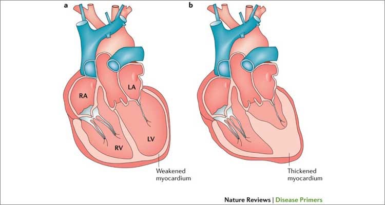 Understanding Coronary Artery Bypass Surgery: Innovations in Minimally ...