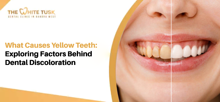 What Causes Yellow Teeth: Exploring Factors Behind Dental Discoloration ...