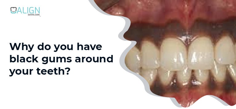 What Causes the Presence of Dark Gums Around Your Teeth? | by Align care | Dec, 2023 | Medium