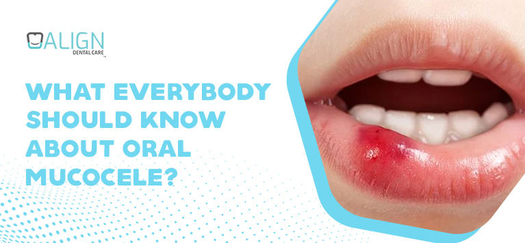What everyone should know about oral mucoceles | by Align care | Jan ...