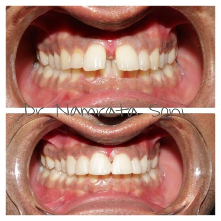 Transform Your Smile with Expert Smile Designing Services in Bhandarkar ...