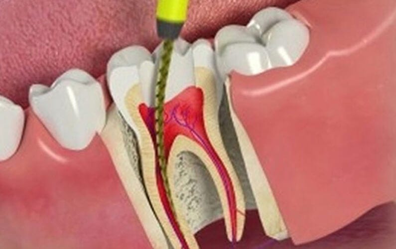 Root Canal Treatment in Pune: Expert Care at Pathak Dental Clinic | by Pathak Dental Clinic ...