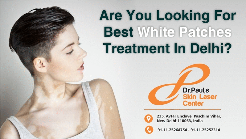 Get Best White Patches Treatment In Delhi? | by Skin Laser Centre | Medium