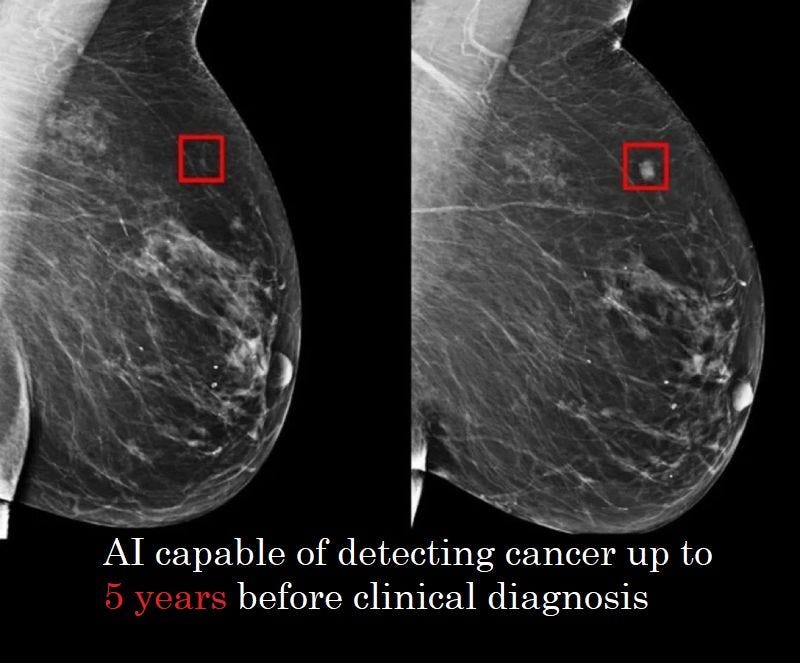 📢 MIT’s AI Breakthrough: Detecting Breast Cancer 5 Years Before ...