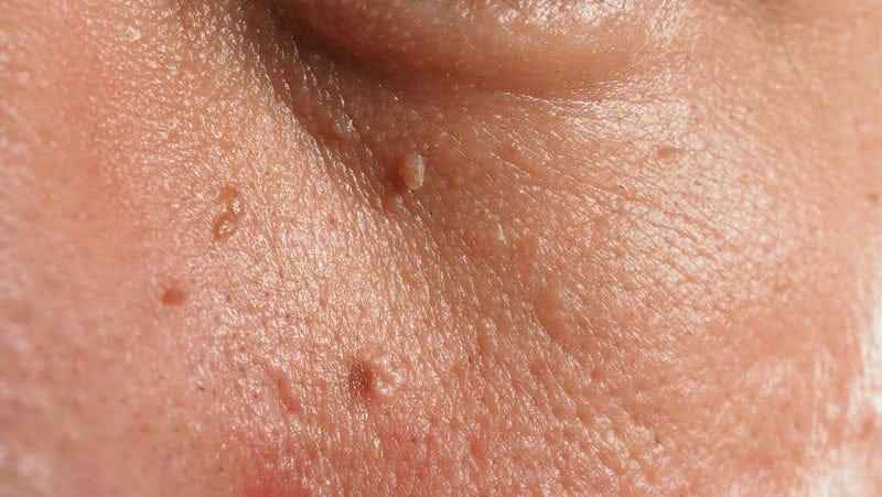 How to Safely Get Rid of These Common Skin Growths | by drahmadclinic ...