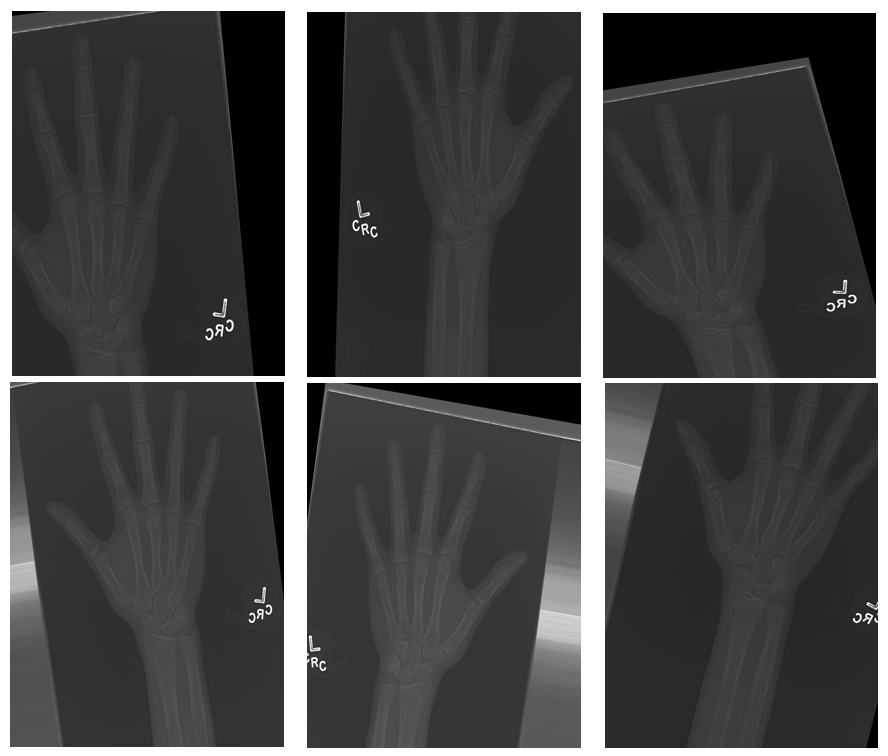 Bone age prediction through x-ray images | by Inside.TechLabs ...