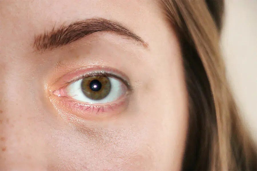 عمليات تجميل العيون الجاحظة. تعتبر عمليات تجميل العيون الجاحظة من… | by BrightVision | Medium