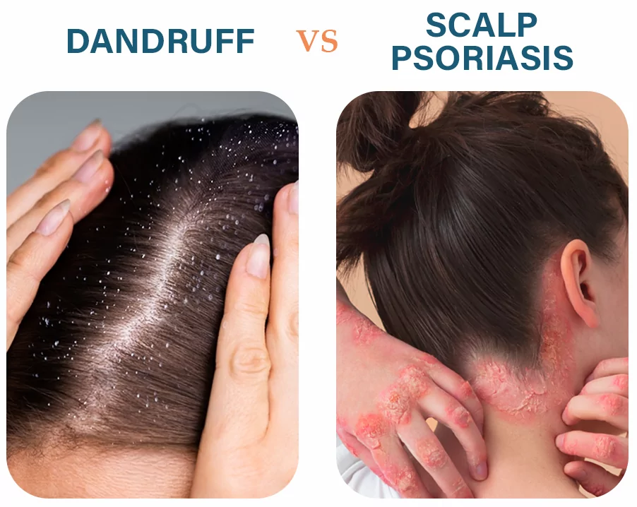 Scalp Psoriasis vs. Dandruff | Medium