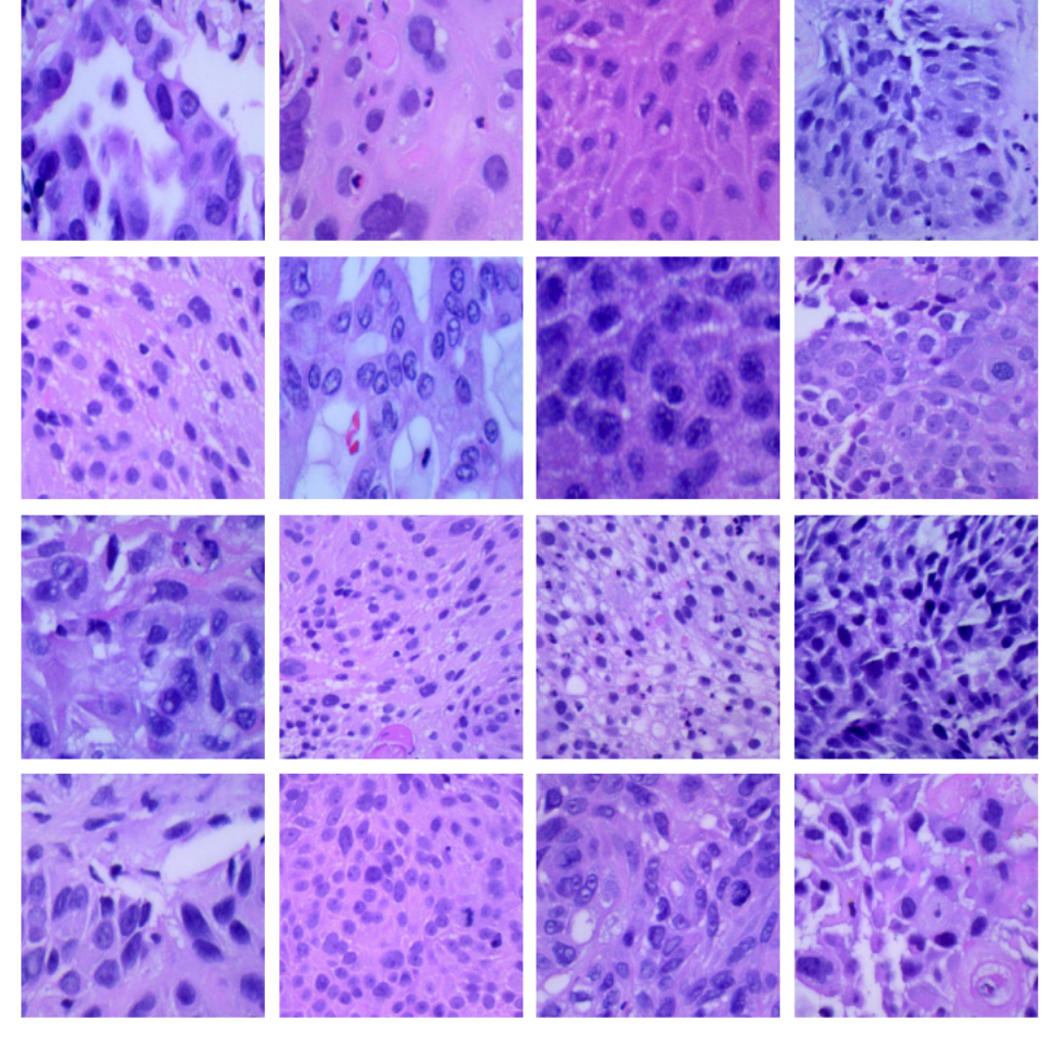 Transfer learning for efficient classification in lung cancer detection ...