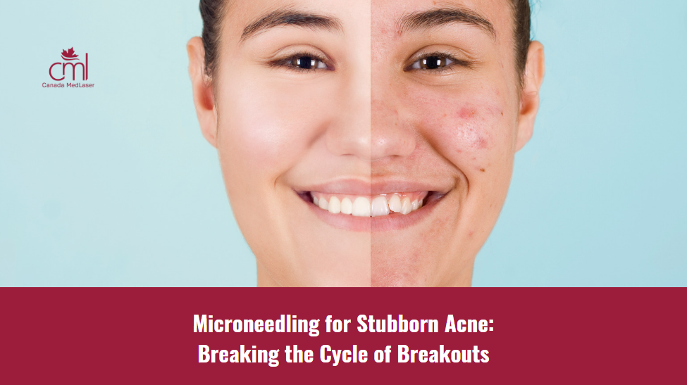 Microneedling for Stubborn Acne: Breaking the Cycle of Breakouts | by ...