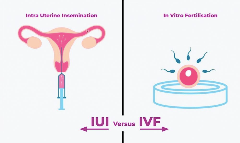 Intrauterine Insemination (IUI): Essential Questions and Answers | by ...