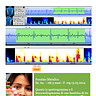 Benign enlargement of the subarachnoid spaces (BESS) | by salvo fedele ...