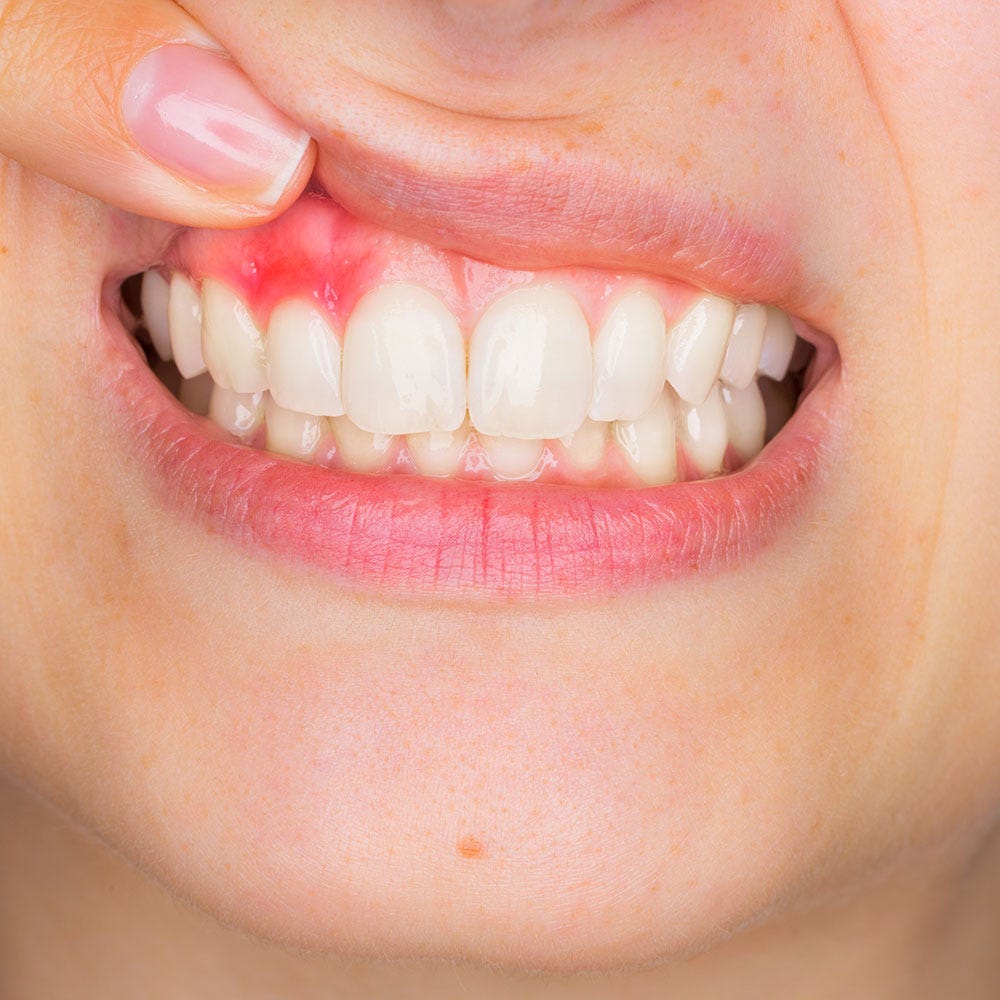 Gingivitis: What Is It? And How to Get Rid of It | by Microdent ...