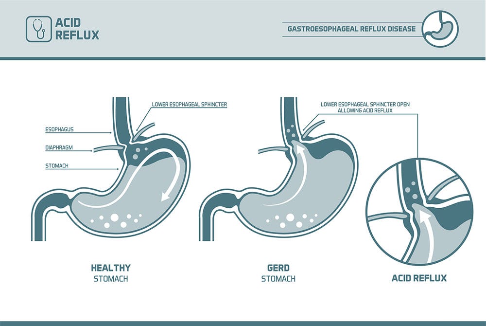 Acid Reflux — Causes, Risk Factors, Symptoms, and Treatment | by ...