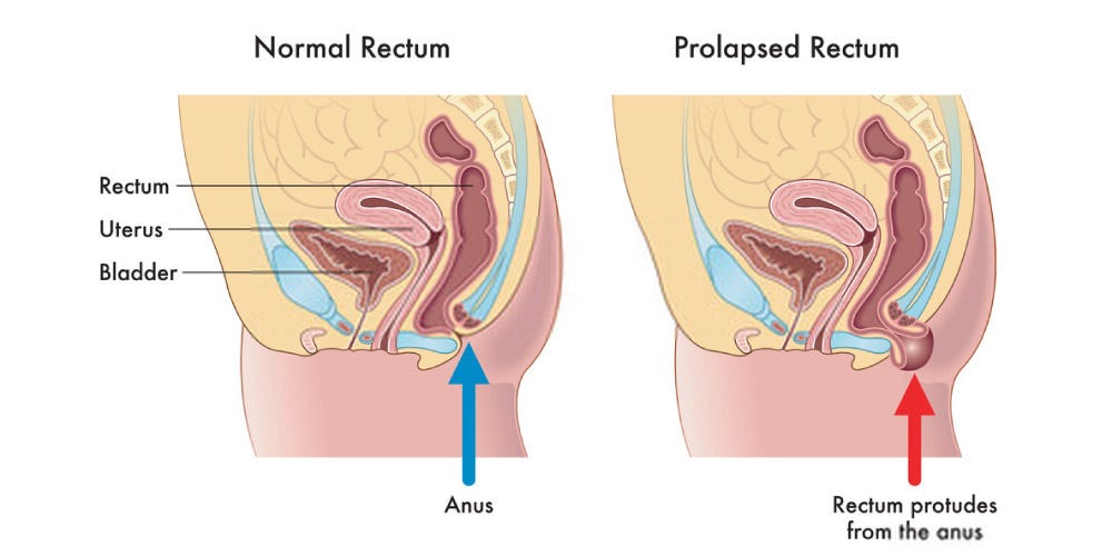 Understanding the Differences Between Rectal Prolapse and Hemorrhoids | by Dr. Avadh Patel | Jul ...