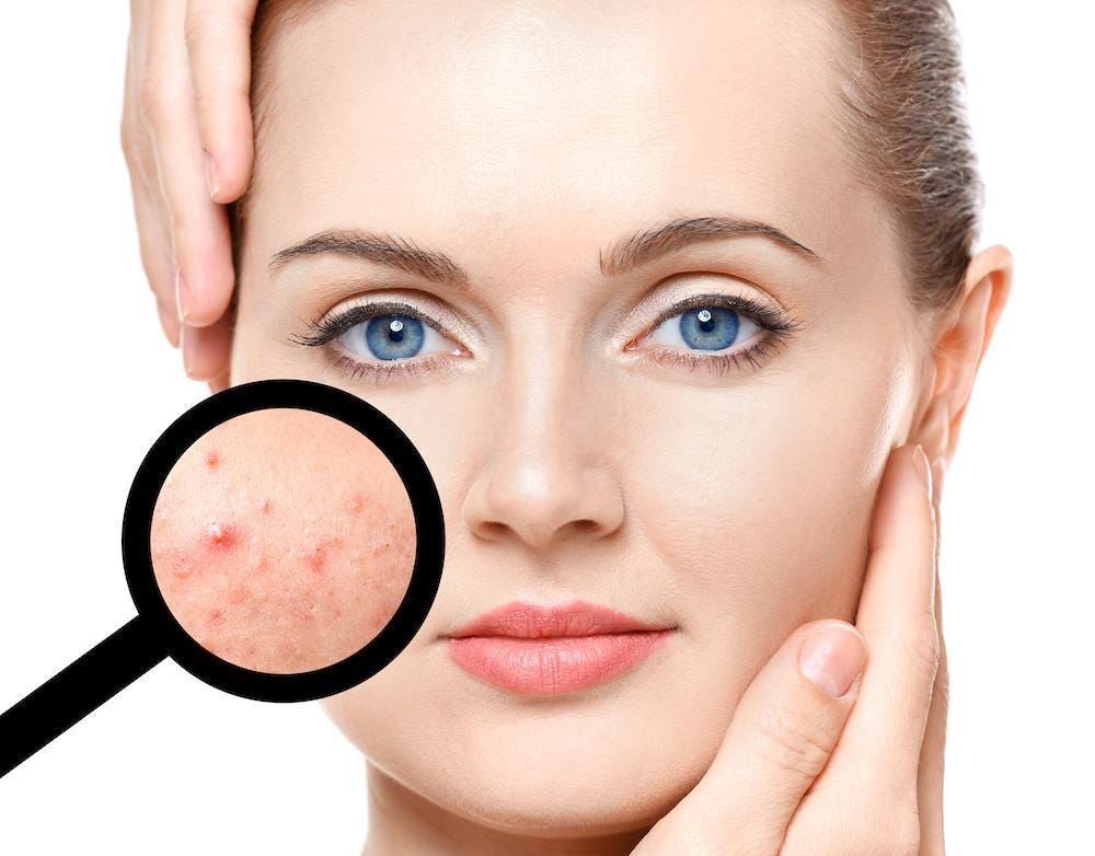 Transform Your Skin: The Best and Worst Foods for Acne | by Healty Skin ...
