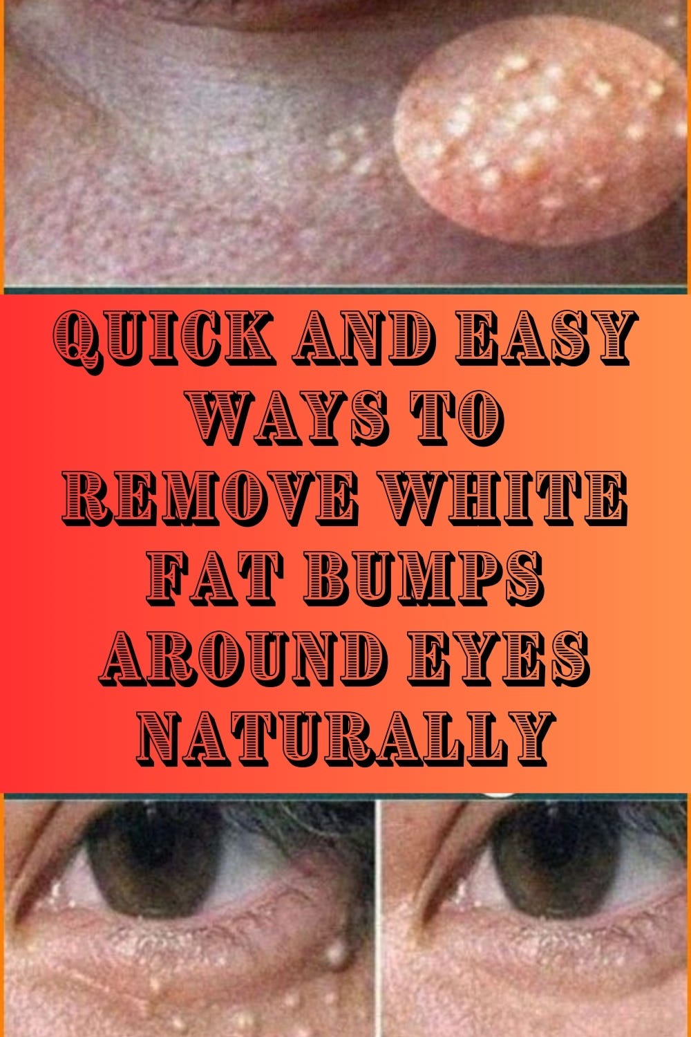 How To Get Rid of White Fat Bumps Around Eyes Naturally - Ashlynout ...