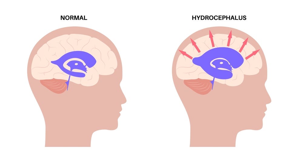 Know more about Hydrocephalus. Hydrocephalus is a situation that… | by ...