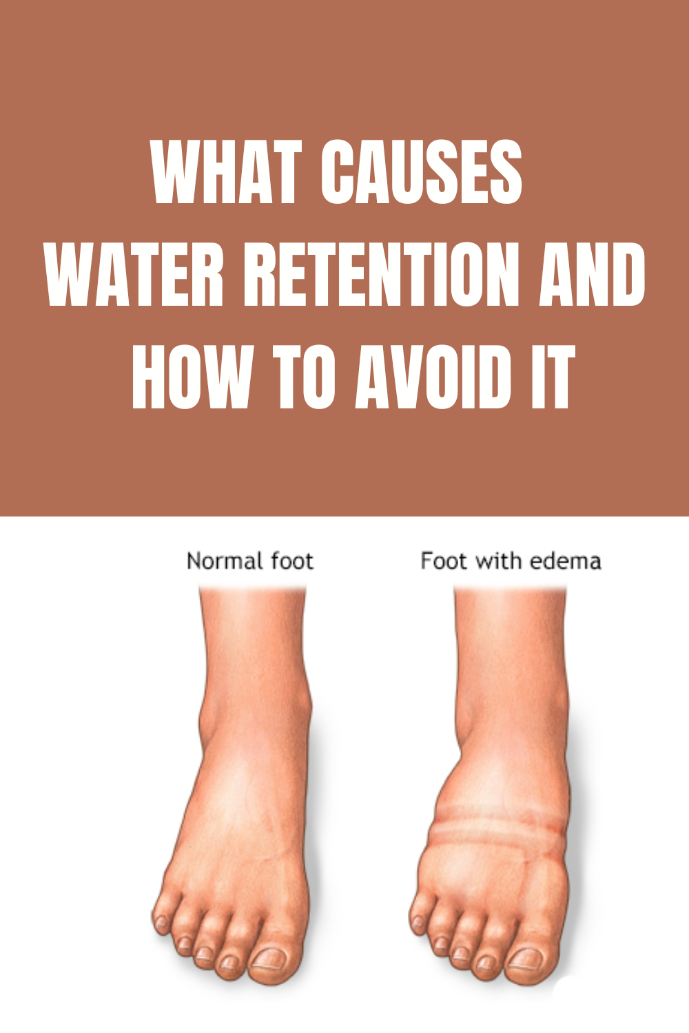 What Causes Water Retention and How to Avoid It - Paula - Medium