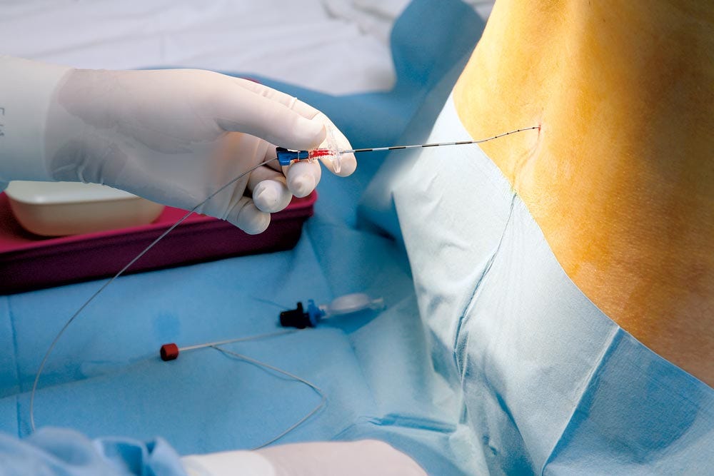 La anestesia epidural. Permite disfrutar de un parto sin… | by Ser ...