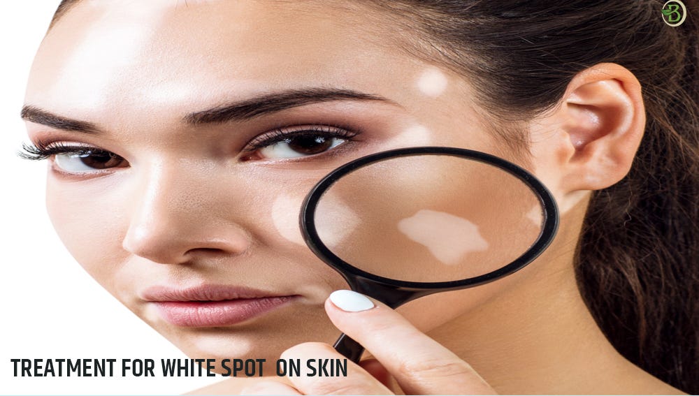 vitiligo medicationEffective Skin White Spot Treatments: Methods for ...