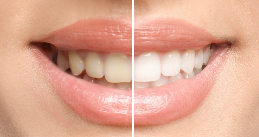 How To Brighten Teeth Without Bleaching? | by Newswithsantosh | May ...