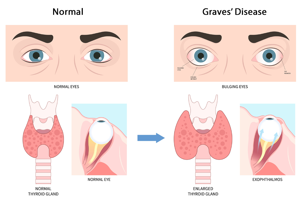 Graves' Disease: An Overview. Graves' disease is an autoimmune… | by ...
