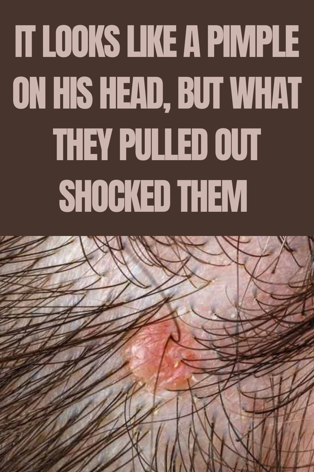 IT LOOKS LIKE A PIMPLE ON HIS HEAD, BUT WHAT THEY PULLED OUT SHOCKED ...