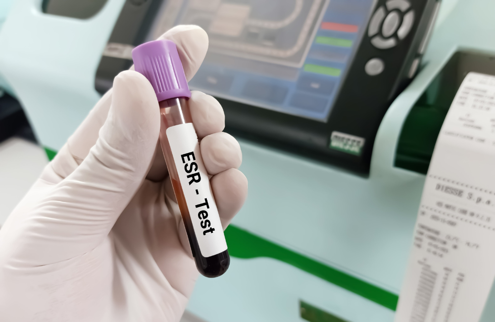 Understanding ESR: How It Works and When to Seek Help | by Supriya ...