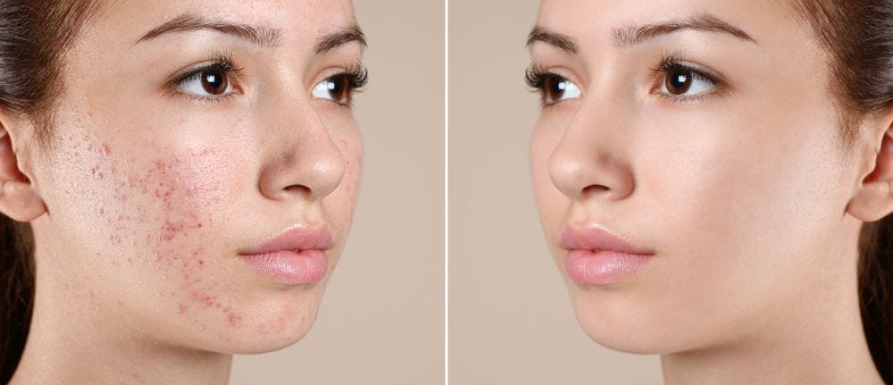 Don`t pop that zit: 10 powerful domestic treatments for pimples | by ...
