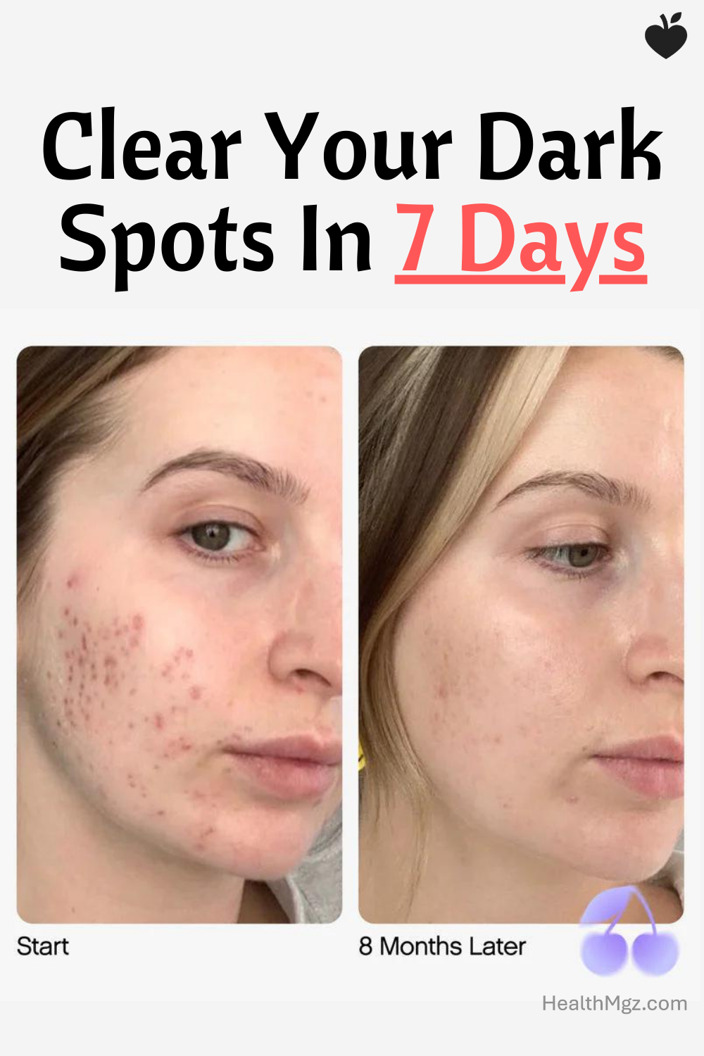 Say Goodbye to Dark Spots: Causes, Types, and Natural Solutions - Emilis Rayner - Medium