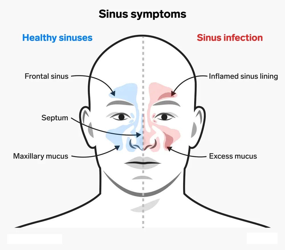 What Causes Sinus Infection? - Post Covid Centers - Medium