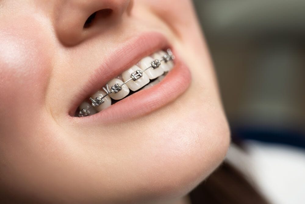 Best Braces for Teens: What to Expect in Dubai | by anaya george | Jul ...