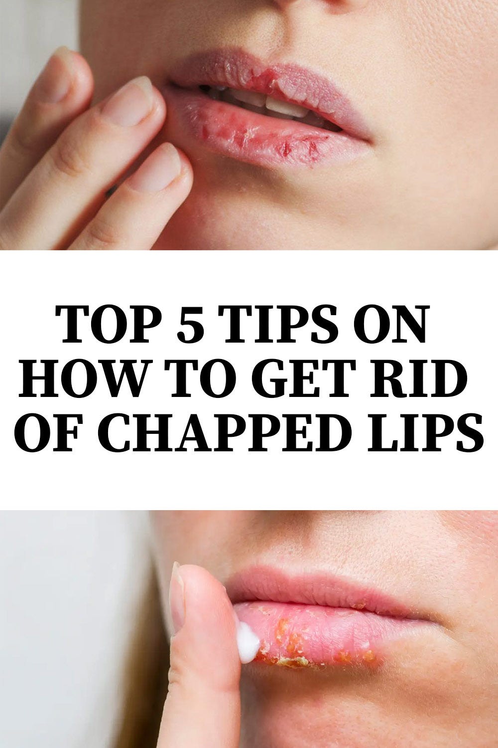 Top 5 Tips On How To Get Rid Of Chapped Lips Ijok Marina Medium