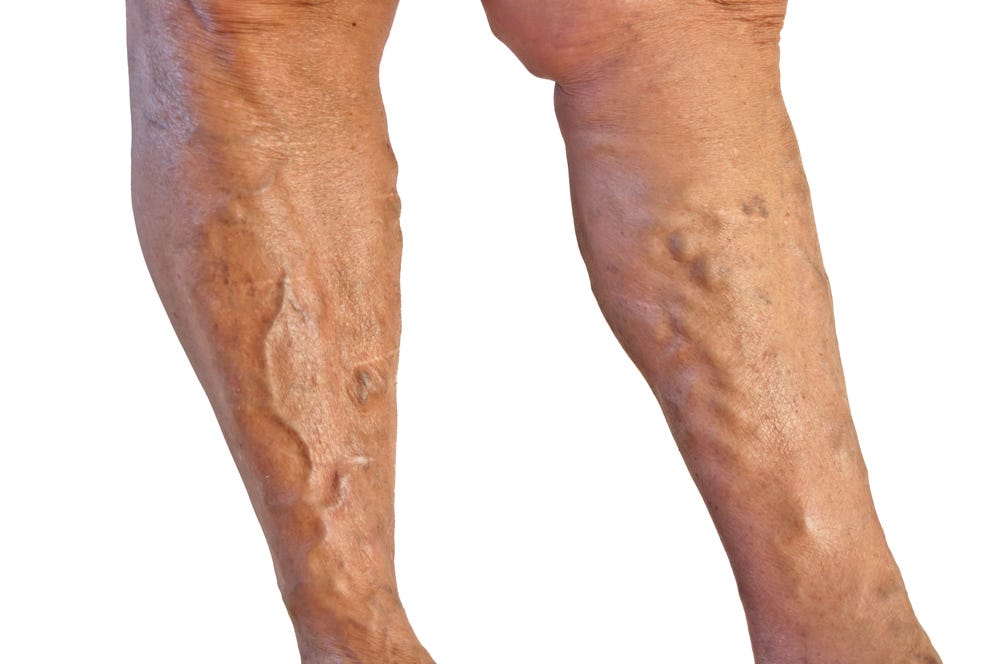 Medical Treatments for Vein Issues | by Allan Bragg | Medium