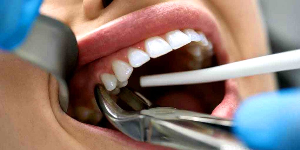 Achieving Comfort: Painless Tooth Extraction at Palm Bay Dental, FL ...