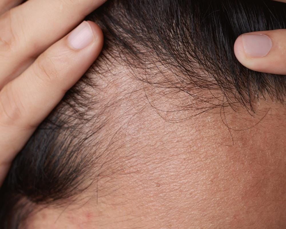 The Leading Causes of Premature Hair Loss A Professional Approach by Sushanta Das Medium