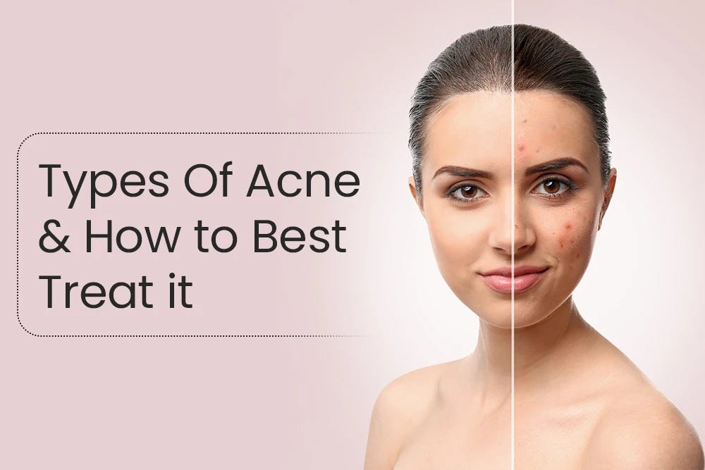 Types Of Acne & How To Best Treat It | by pevonia india | Medium